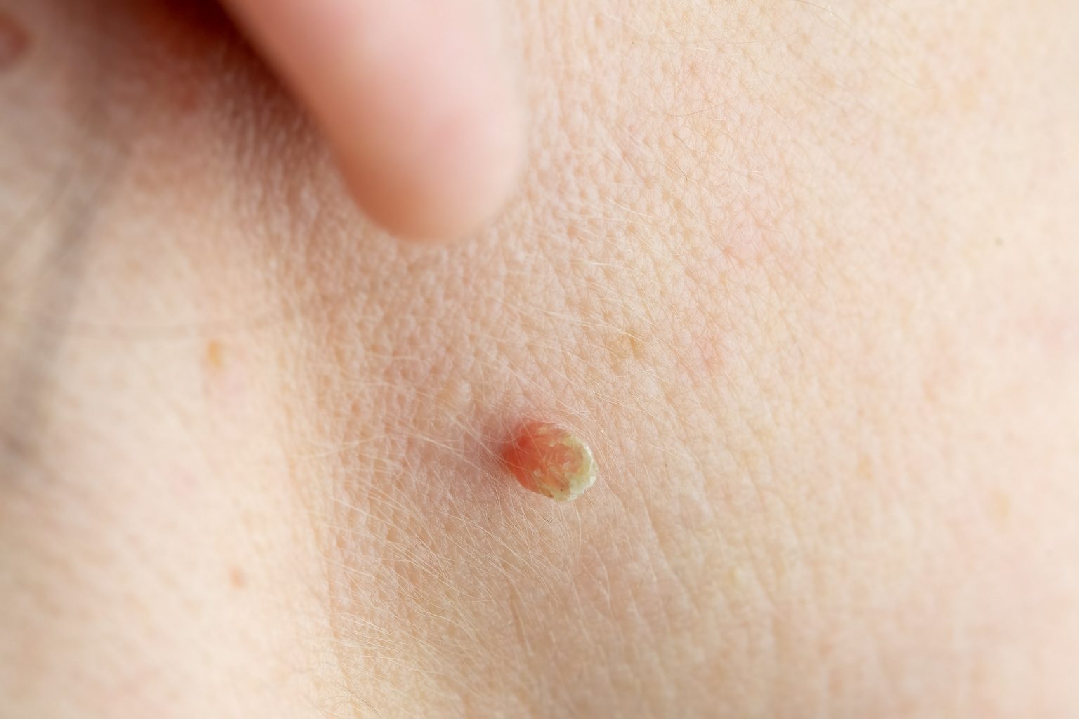 Should You Remove a Skin Tag Yourself? | Dr Skin Surgery Blog